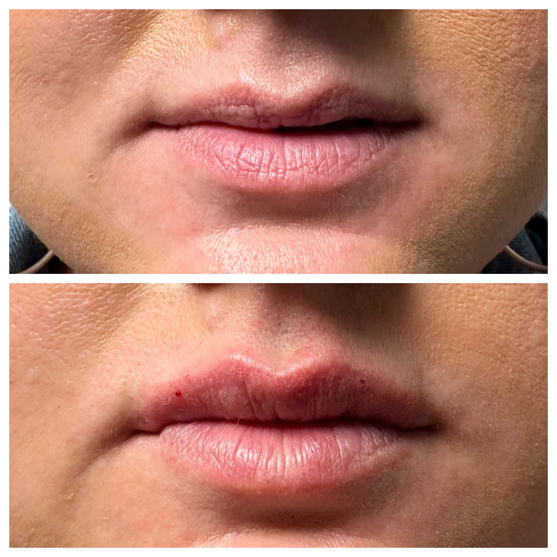 Dermal Fillers Bournemouth & Poole | Beauty Sculpting Room Filler